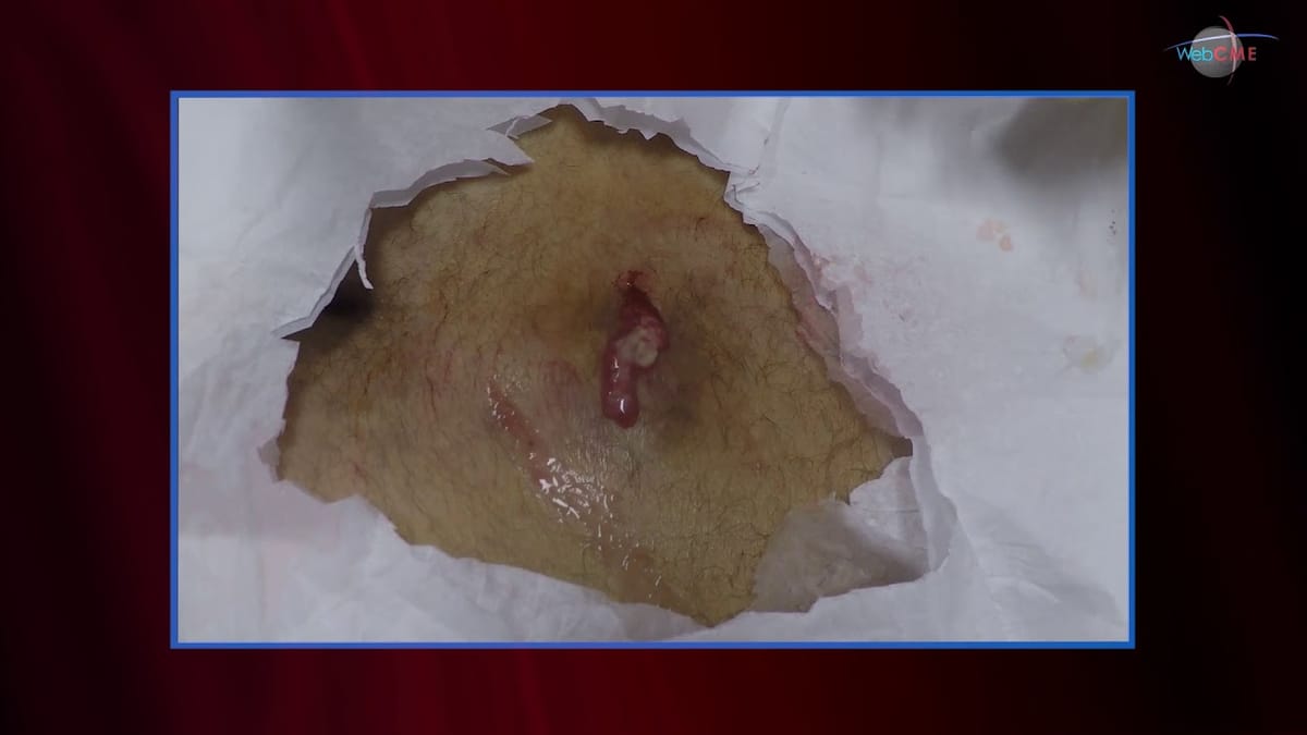 The BFD | Cyst Saturday: Draining an Abscess on the Lower Back